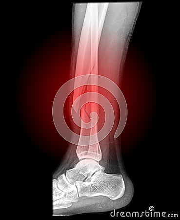 Open Fracture Of The Leg With Dislocation Stock Photos - Image: 13362453