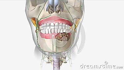 Oral Cancer on Gums Stage 2 Stock Footage - Video of dental, rebuilding ...