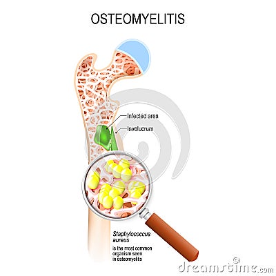 Osteomyelitis Is Infection In The Bone. Close-up Bacteria ...