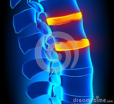 Osteophyte Formation Disc Degeneration Royalty Free Stock Images ...