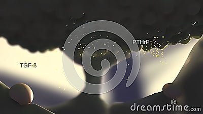 Osteosarcoma Is The Most Common Bone Cancer Royalty-Free Illustration ...