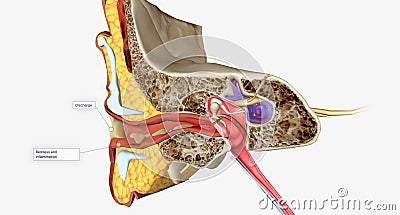 An Outer Ear Infection, Also Called Otitis Externa Royalty-Free Stock ...