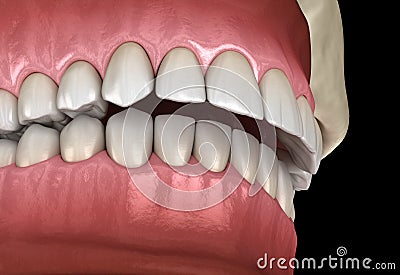 Overbite Dental Occlusion Malocclusion Of Teeth . Medically Accurate ...
