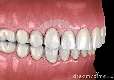 Overbite Dental Occlusion Malocclusion Of Teeth . Medically Accurate ...