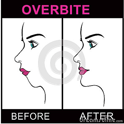 Overbite Cartoon Vector | CartoonDealer.com #54183693