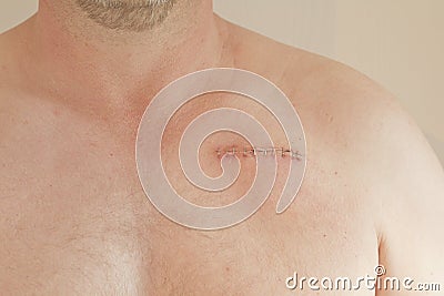 Pacemaker Scar Royalty Free Stock Photo - Image: 25735675