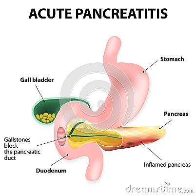 Pancréatite Aiguë Illustration de Vecteur - Image: 45172565