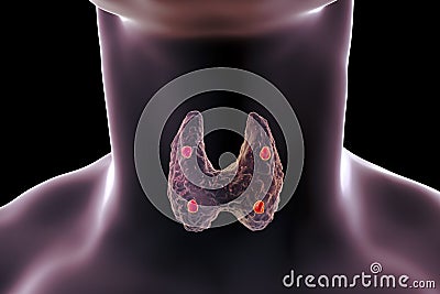 Parathyroid Glands Anatomy Royalty-Free Illustration | CartoonDealer ...