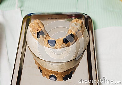 A Partial Denture Mounted On A Plaster Study Model Royalty-Free Stock ...