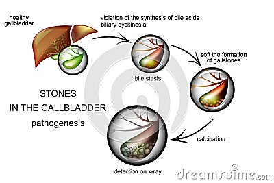 The Pathogenesis Of Gallstones Cartoon Vector | CartoonDealer.com #64521363