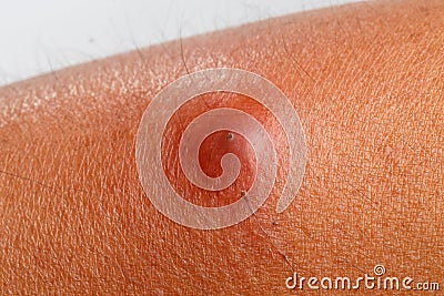 The Patient Had An Abscess On His Arm. Royalty-Free Stock Image ...