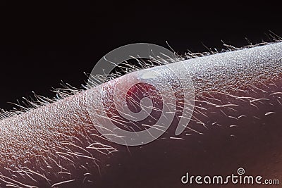The Patient Had An Abscess On His Arm Stock Photo | CartoonDealer.com ...