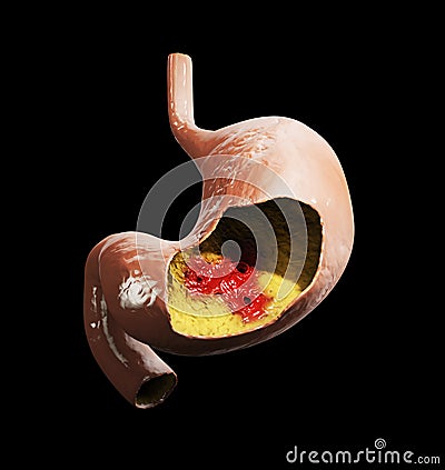 Peptic Ulcer. 3d Illustration Of Human Stomach Anatomy Royalty-Free ...