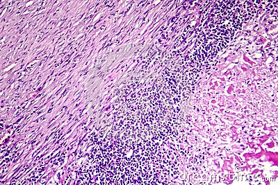 Pericarditis, Light Micrograph, Photo Under Microscope | CartoonDealer ...