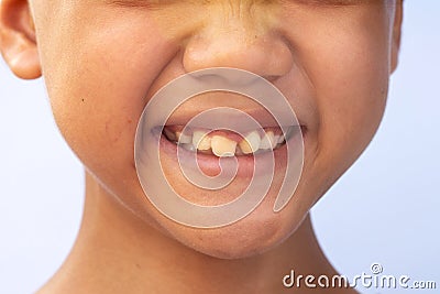 The Permanent Teeth In Front Of Boys Aged 8 To 10 Years That Are ...