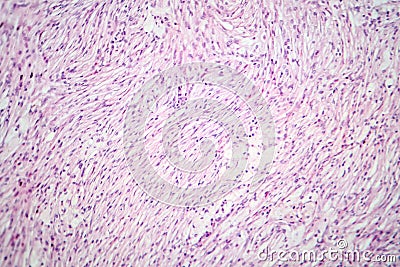 Photomicrograph Of A Giant Cell Tumor Of Bone, Revealing Its Cellular ...