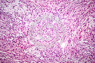 Photomicrograph Of A Giant Cell Tumor Of Bone, Revealing Its Cellular ...