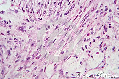 Photomicrograph Of A Giant Cell Tumor Of Bone, Revealing Its Cellular ...