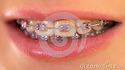 Pink Braces Stock Photo - Image: 40990748