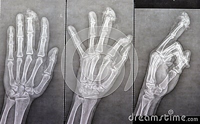 Plain X-Ray Reveals Distal Tip Amputation Of Distal Phalanx Of The ...