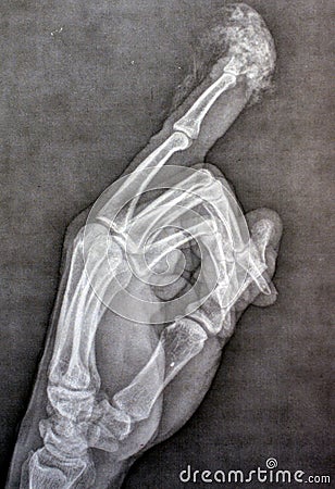 Plain X-Ray Reveals Distal Tip Amputation Of Distal Phalanx Of The ...