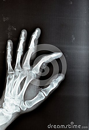 Plain X Ray Shows Avulsion Fracture Base Of The Distal Phalanx Of The ...