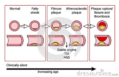 Plaque Formation In Artery Vector Illustration | CartoonDealer.com ...