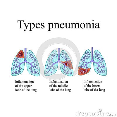 Pneumonia. The Anatomical Structure Of The Human Lung. Type Of ...