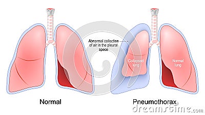 Pneumothorax. Normal, And Collapsed Lungs Cartoon Vector ...