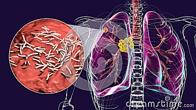 Primary Lung Tuberculosis, 3D Illustration Royalty-Free Cartoon ...