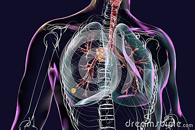 Primary Lung Tuberculosis With The Ranke Complex, 3D Illustration ...
