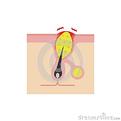 Cross Section Of Pores Illustration / Papule Cartoon Vector ...