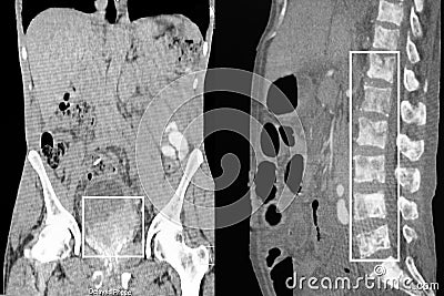 Prostatakrebs, Knochenmetastasen Dieses Ist Das Einzigartige Bild Des ...