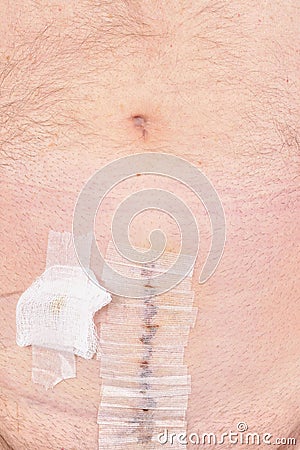 Prostate Cancer Surgery Operation Royalty Free Stock Images - Image ...