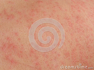 Prurido De Pele Fotos de Stock Royalty Free - Imagem: 167168