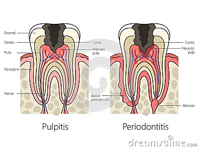 Pulpitis And Periodontitis Diagram Medical Science Royalty-Free ...