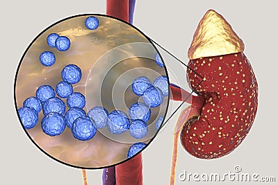 Pyelonephritis, Medical Concept, And Close-up View Of Bacteria, The ...