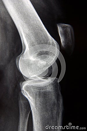 Radiografía Normal De La Rodilla Fotografía de archivo - Imagen: 14088732