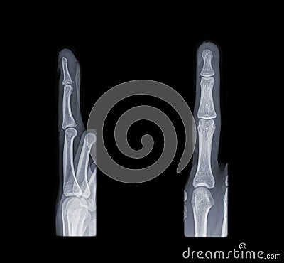 Radiografía Del Dedo Fotos de archivo - Imagen: 14031903
