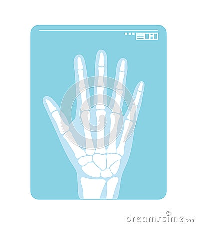 Radiogram Of Hand. X-ray Or Roentgenogram. Vector Illustration Of ...
