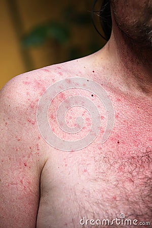 Rash Or Sun Allergy Stock Photography - Image: 14962602