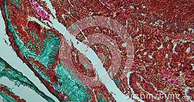 Rectum carcinoma tissue stock footage. Video of magnification - 206150232