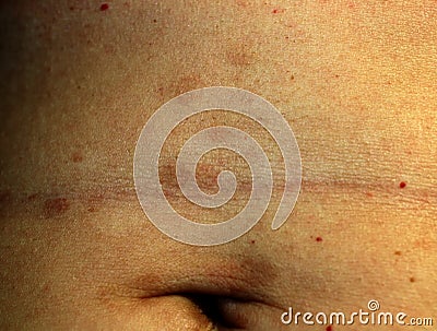 Red Flat Lichen Planus. Red Spots On The Skin Of The Abdomen Stock ...