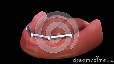 Removable Partial Denture, Mandibular Prosthesis. Medically Accurate 3D ...
