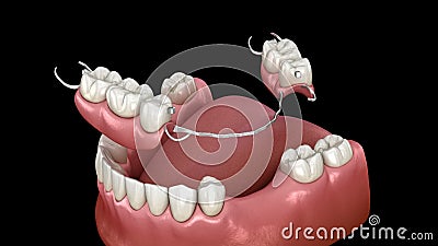 Removable Partial Denture, Mandibular Prosthesis. Medically Accurate 3D ...