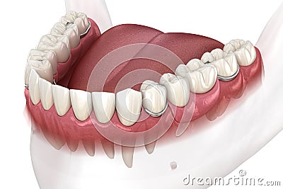 Removable Partial Denture, Mandibular Prosthesis. Medically Accurate 3D ...