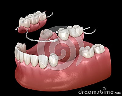 Removable Partial Denture, Mandibular Prosthesis. Medically Accurate 3D ...