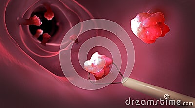 Removal Of A Colonic Polyp With A Electrical Wire Loop During A ...