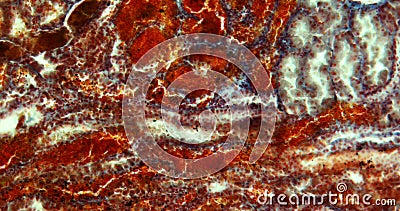 Renal bleeding tissue stock video. Video of liver, sickness - 196631473