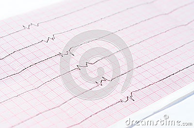 ECG With Single Ventricular Complexes And And Ventricular Asystole ...
